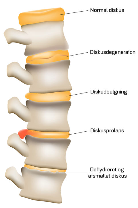 DISKUSPROLAPS - Skoliose